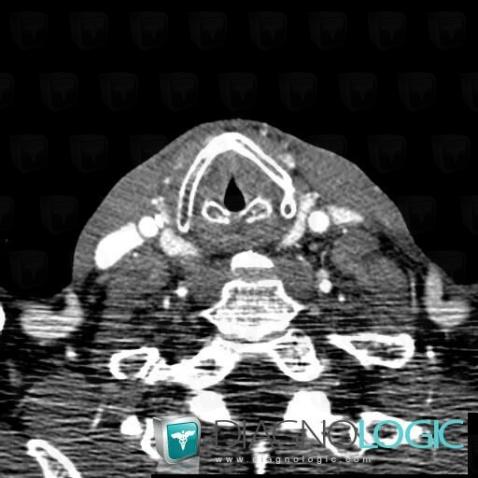 Cas radiologie : œdème postradique (Scanner) - Diagnologic