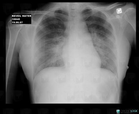 Cas radiologie : œdème pulmonaire (Radio) - Diagnologic