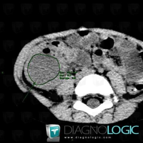 Cas radiologie : Abcès (Scanner ,Echographie) - Diagnologic