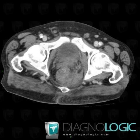 Ischioanal Fossa Abscess Ct