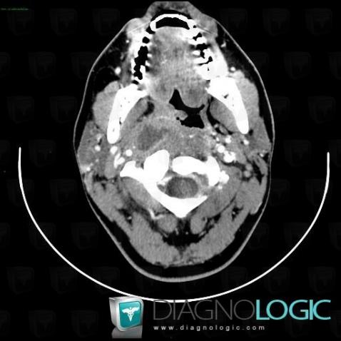 Parapharyngeal Space Abscess Radiology