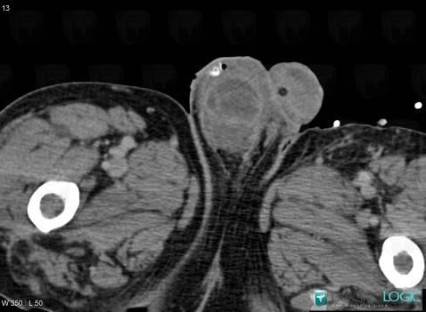 Radiology case : Abscess (CT) - Diagnologic