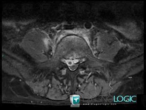Radiology case : Abscess (MRI) - Diagnologic