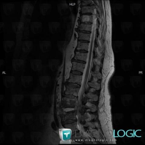 Radiology case : Abscess (MRI) - Diagnologic