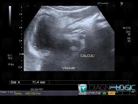 Radiology case : Acute cholecystitis (US) - Diagnologic