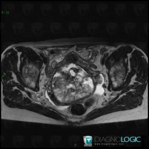 Cas radiologie : Adénocarcinome de l'endomètre (IRM ,Scanner) - Diagnologic