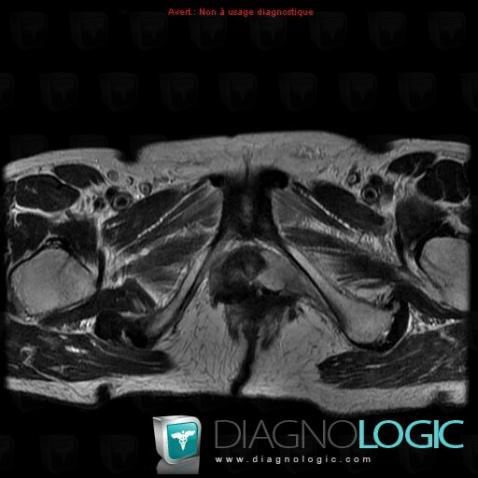 Bartholin Gland Cyst Mri Full Article: Direct Colo Labial Crohn's