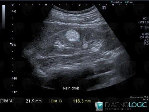Cas radiologie : Angiomyolipome (Echographie) - Diagnologic