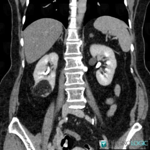 Cas radiologie : Angiomyolipome (Scanner) - Diagnologic