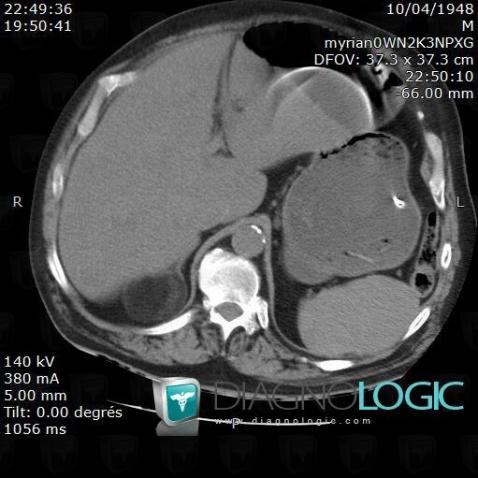 Cas radiologie : Angiomyolipome (Scanner) - Diagnologic