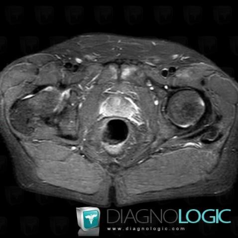 Radiology case : Ankylosing spondylitis (MRI) - Diagnologic