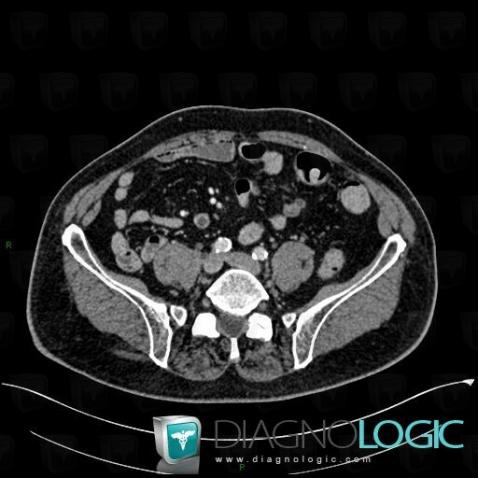 Cas radiologie : Anomalie de rotation du mésentère (Scanner) - Diagnologic
