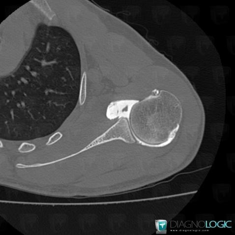 Radiology case : Anterior labral lesion / Shoulder (CT) - Diagnologic