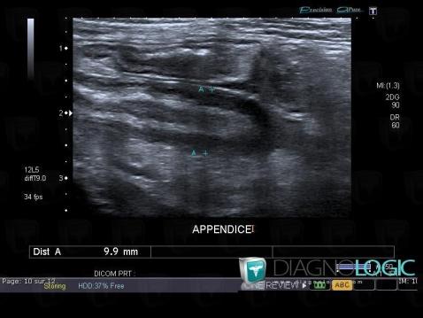 Radiology case : Appendicitis (US) - Diagnologic
