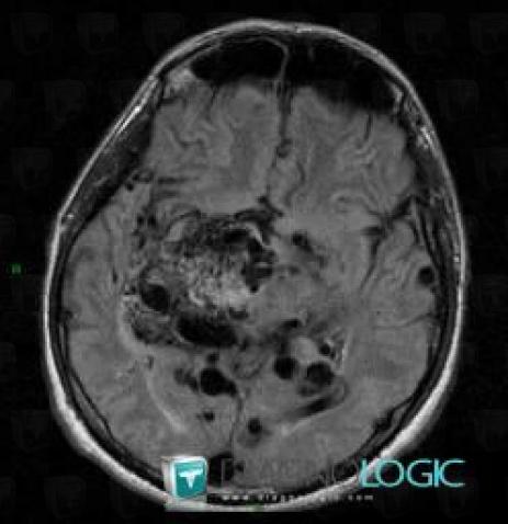Radiology case : Arteriovenous malformation (MRI) - Diagnologic