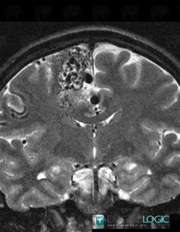 Radiology case : Arteriovenous malformation (MRI) - Diagnologic