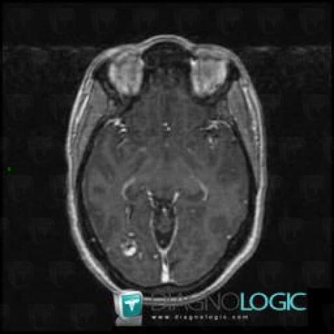 Radiology case : Arteriovenous malformation (MRI) - Diagnologic