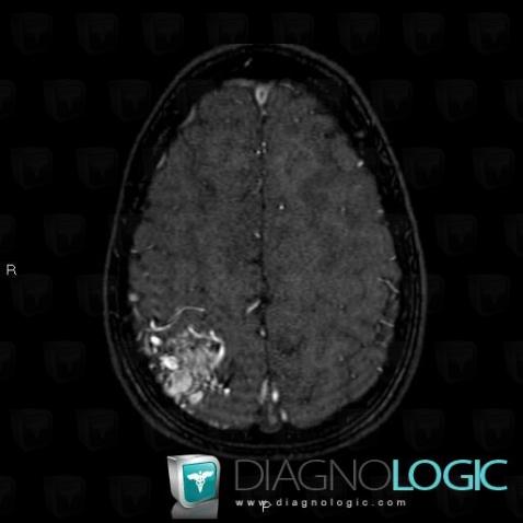 Radiology case : Arteriovenous malformation (MRI) - Diagnologic
