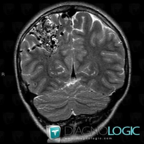 Radiology case : Arteriovenous malformation (MRI) - Diagnologic