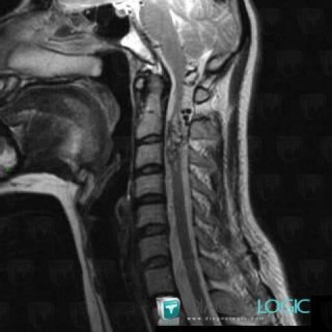 Radiology case : Arteriovenous malformation (MRI) - Diagnologic