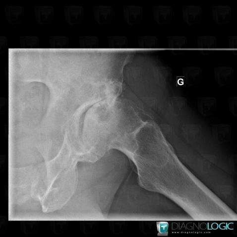 Cas radiologie : Arthrose (Radio) - Diagnologic