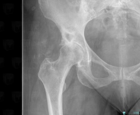 Cas radiologie : Arthrose (Radio) - Diagnologic