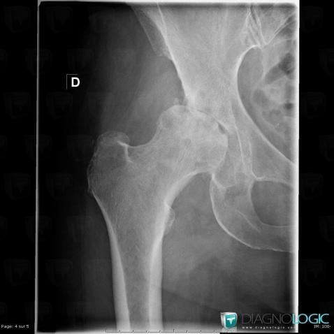 Cas radiologie : Arthrose (Radio) - Diagnologic