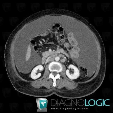 Radiology case : Ascites (CT) - Diagnologic