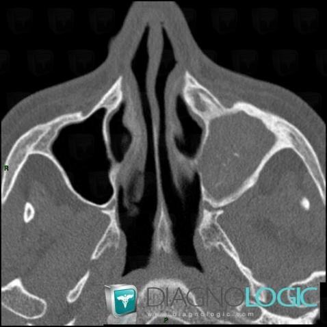 Cas radiologie : Dent incluse (Scanner) - Diagnologic