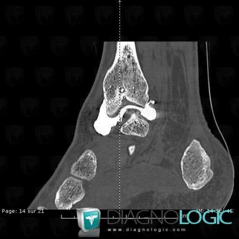 Radiology case : Avascular necrosis (CT) - Diagnologic