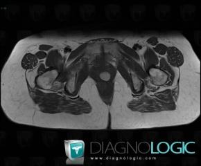 Bartholin Gland Cyst Mri Full Article: Direct Colo Labial Crohn's