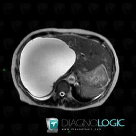 Cas radiologie : Bilome (IRM ,Scanner) - Diagnologic