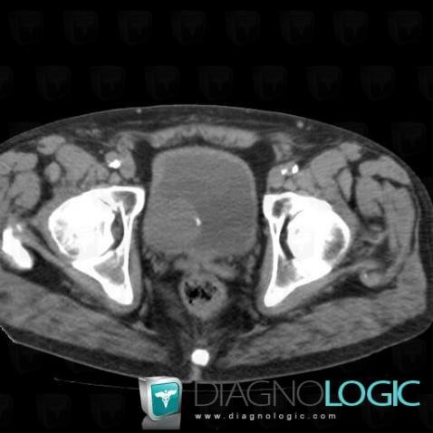 Radiology case : Bladder transitional cell carcinoma (CT ,US) - Diagnologic