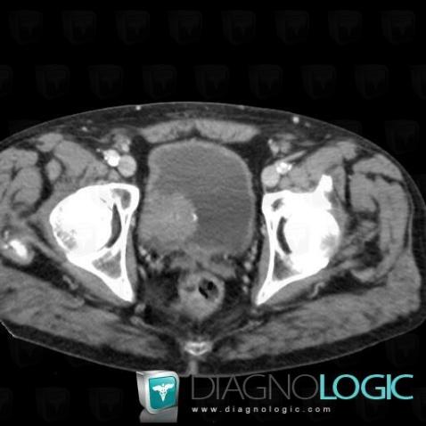 Radiology case : Bladder transitional cell carcinoma (CT ,US) - Diagnologic
