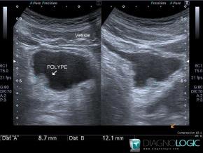 Thickening Of Bladder Wall International Neurourology Journal