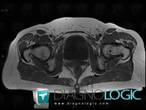 Radiology case : Bone island (MRI ,X rays) - Diagnologic