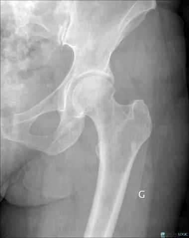 Radiology case : Bone island (MRI ,X rays) - Diagnologic