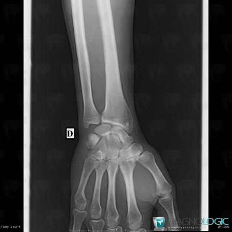 Radiology case : Bone island (X rays) - Diagnologic