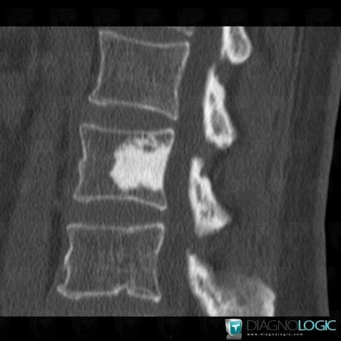 Radiology case : Bone island (CT) - Diagnologic