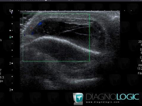 Cas radiologie : Bosse séro-sanguine (Echographie) - Diagnologic