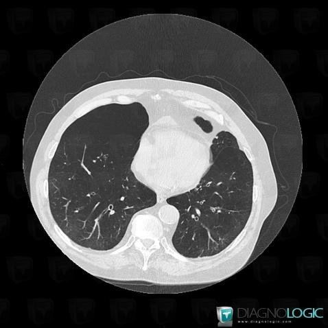 Cas radiologie : Emphysème centrolobulaire (Scanner) - Diagnologic