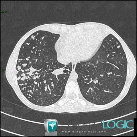 Radiology case : Cystic fibrosis (CT) - Diagnologic