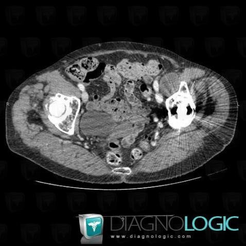 Cas radiologie : Bursite (TDM) - Diagnologic