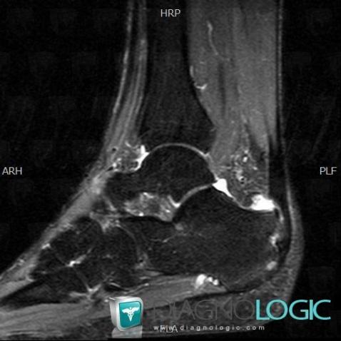 Radiology case : Bursitis (MRI) - Diagnologic