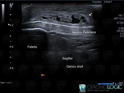 Radiology case : Bursitis (US) - Diagnologic