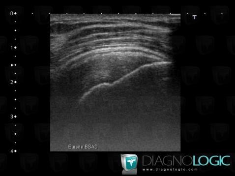 Radiology case : Bursitis (US) - Diagnologic