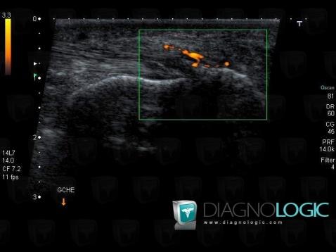 Radiology case : Calcaneal enthesopathy (US) - Diagnologic