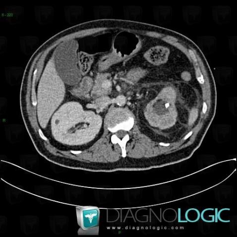 Cas radiologie : Calcul (Radio ,Scanner) - Diagnologic