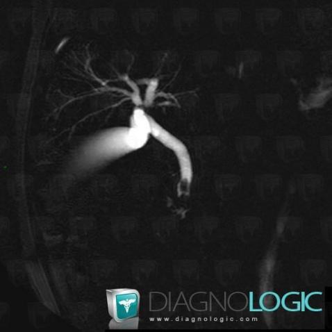 Radiology case : Calculus (MRI) - Diagnologic