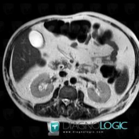 Radiology case : Calculus (MRI) - Diagnologic
